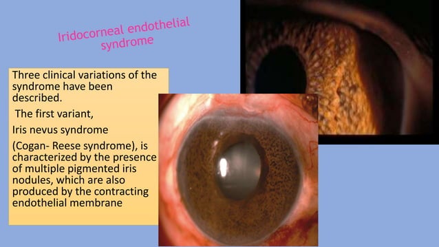 Corneal degeneration and corneal deposition | PPT