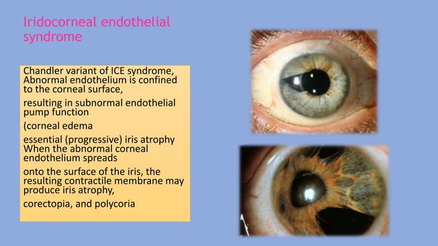 Corneal degeneration and corneal deposition | PPT