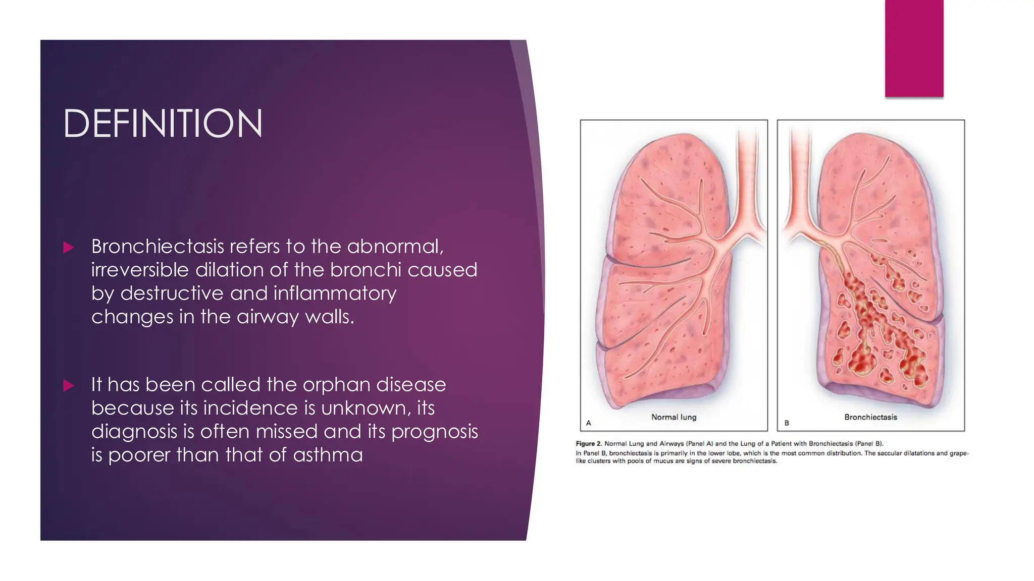 Bronchiectasis and Physiotherapy Management | PDF