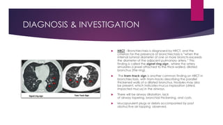 Bronchiectasis and Physiotherapy Management | PDF