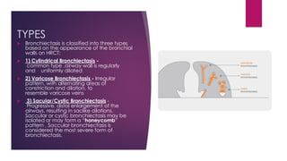 Bronchiectasis and Physiotherapy Management | PDF