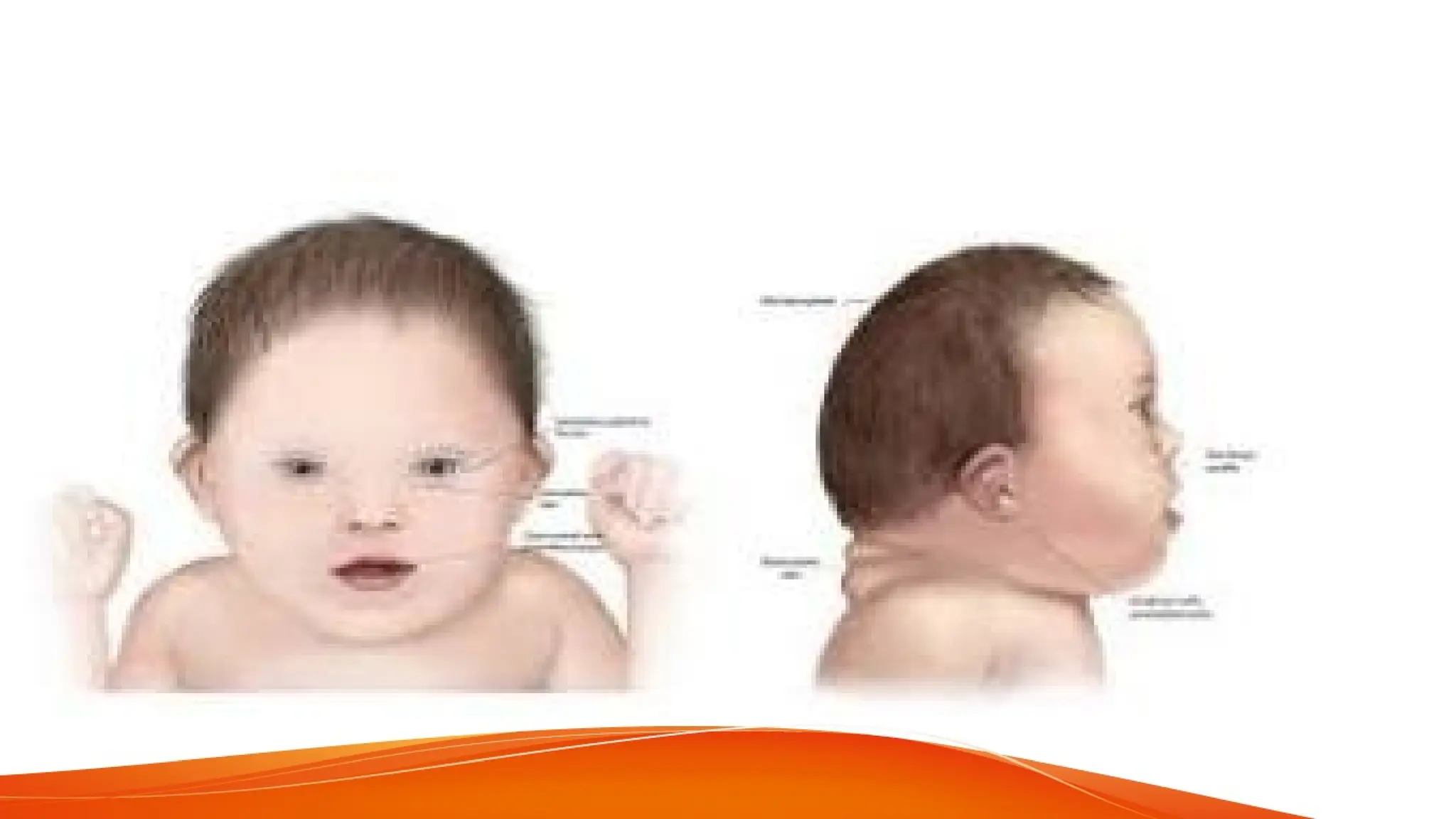 Presentation2.pptx DOWN SYNDROME.pptx down syndrome | PPT