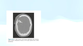 Presentation 2.pptx Invg and mgmt f brain | PPTX
