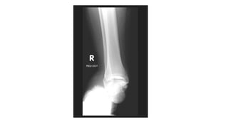 Subtalar dislocation and calcaneus fractures 2.pptx