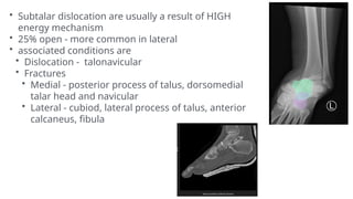 Subtalar dislocation and calcaneus fractures 2.pptx