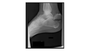 Subtalar dislocation and calcaneus fractures 2.pptx