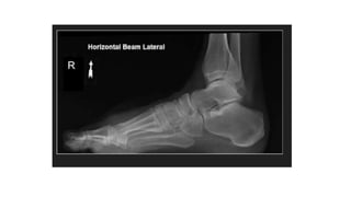 Subtalar dislocation and calcaneus fractures 2.pptx