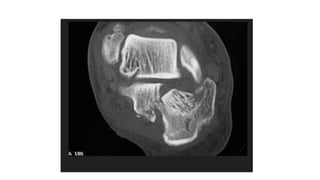 Subtalar dislocation and calcaneus fractures 2.pptx
