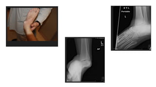 Subtalar dislocation and calcaneus fractures 2.pptx