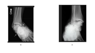 Subtalar dislocation and calcaneus fractures 2.pptx