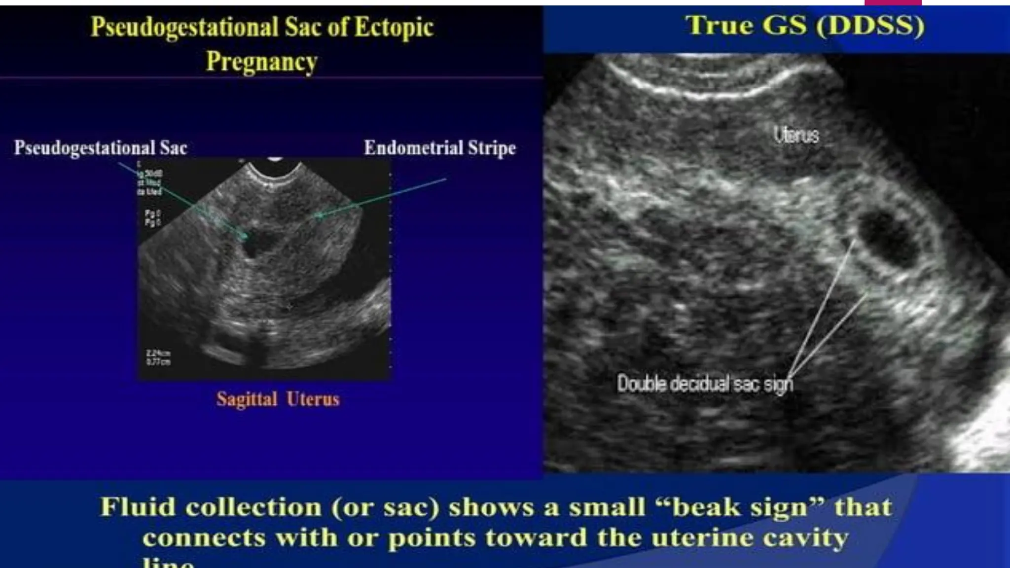 Investigation and USG in pregnancy -1st trimester | PPT