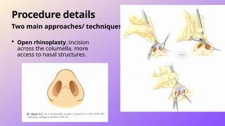 Rhinoplasty- A Comprehensive inside into nasal reconstruction .pptx