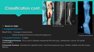 Fractures and classification , Treatment , Complications | PPTX