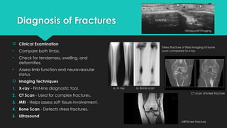 Fractures and classification , Treatment , Complications | PPTX
