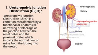 Disease of ureter and that of pelviureteric junction | PPTX
