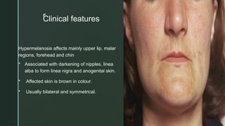 Common hyperpigmentation disorder- melasma | PPTX
