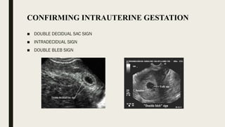 First trimester ultrasound evaluation timeline | PPTX