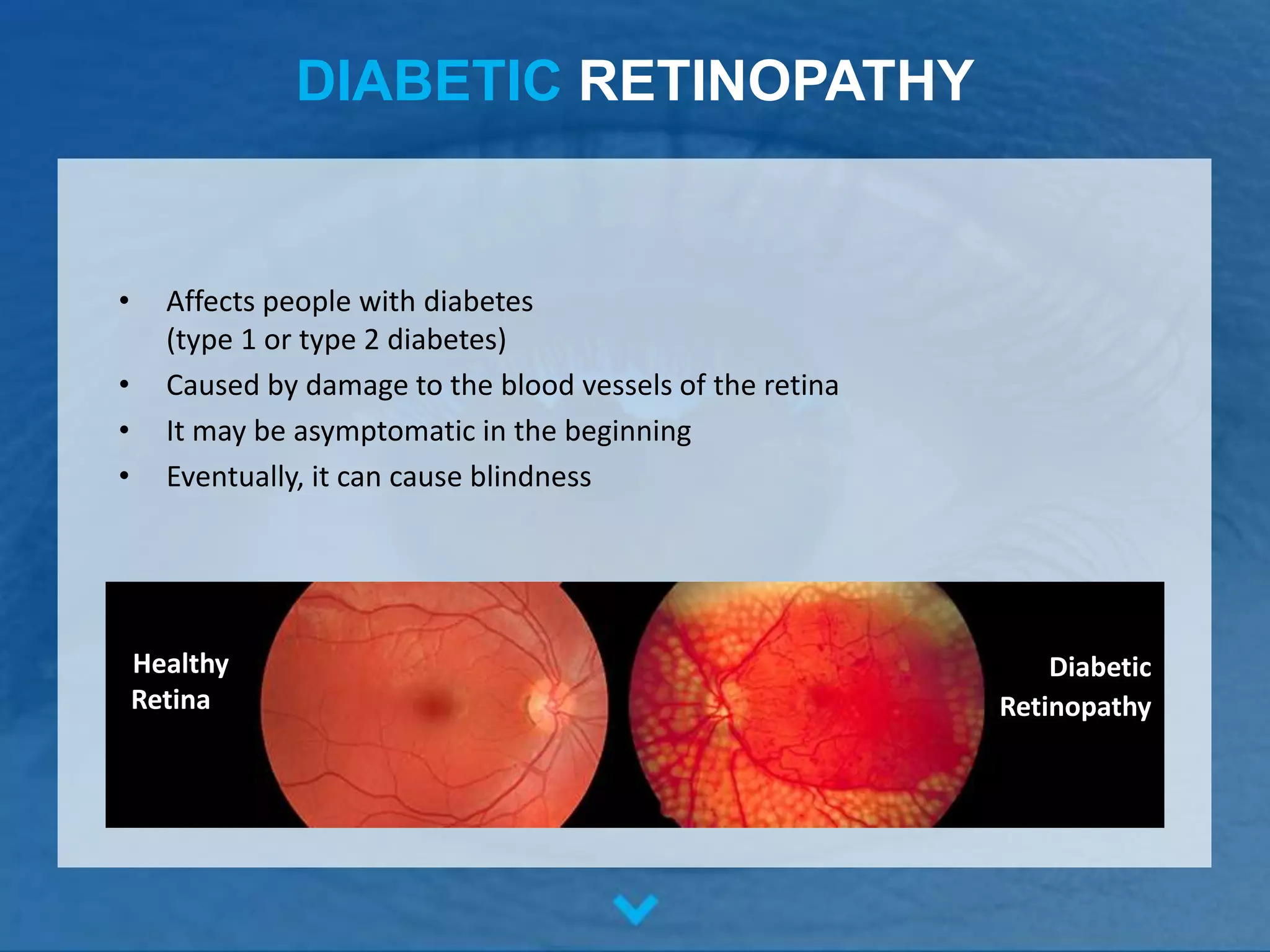 The Most Common Retinal Diseases | PPTX