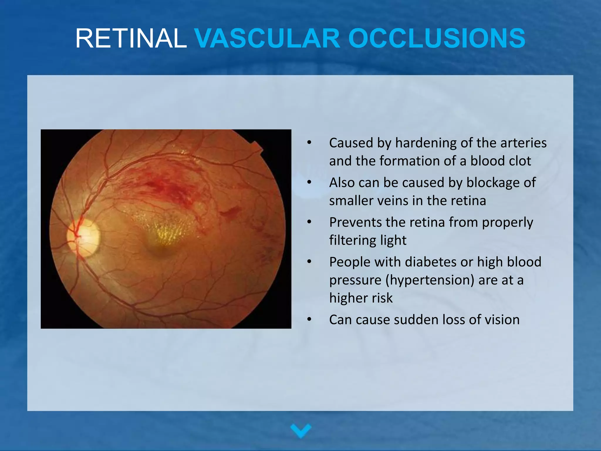 The Most Common Retinal Diseases | PPTX