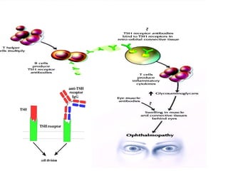 Pathophysiology of Graves Orbitopathy | PPT