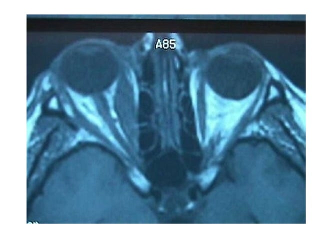 Pathophysiology of Graves Orbitopathy | PPT
