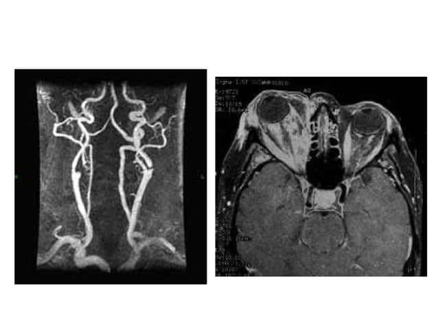 Pathophysiology of Graves Orbitopathy | PPT