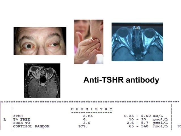Pathophysiology of Graves Orbitopathy | PPT