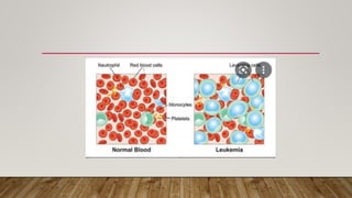 Presentation on leukaemia | PPTX