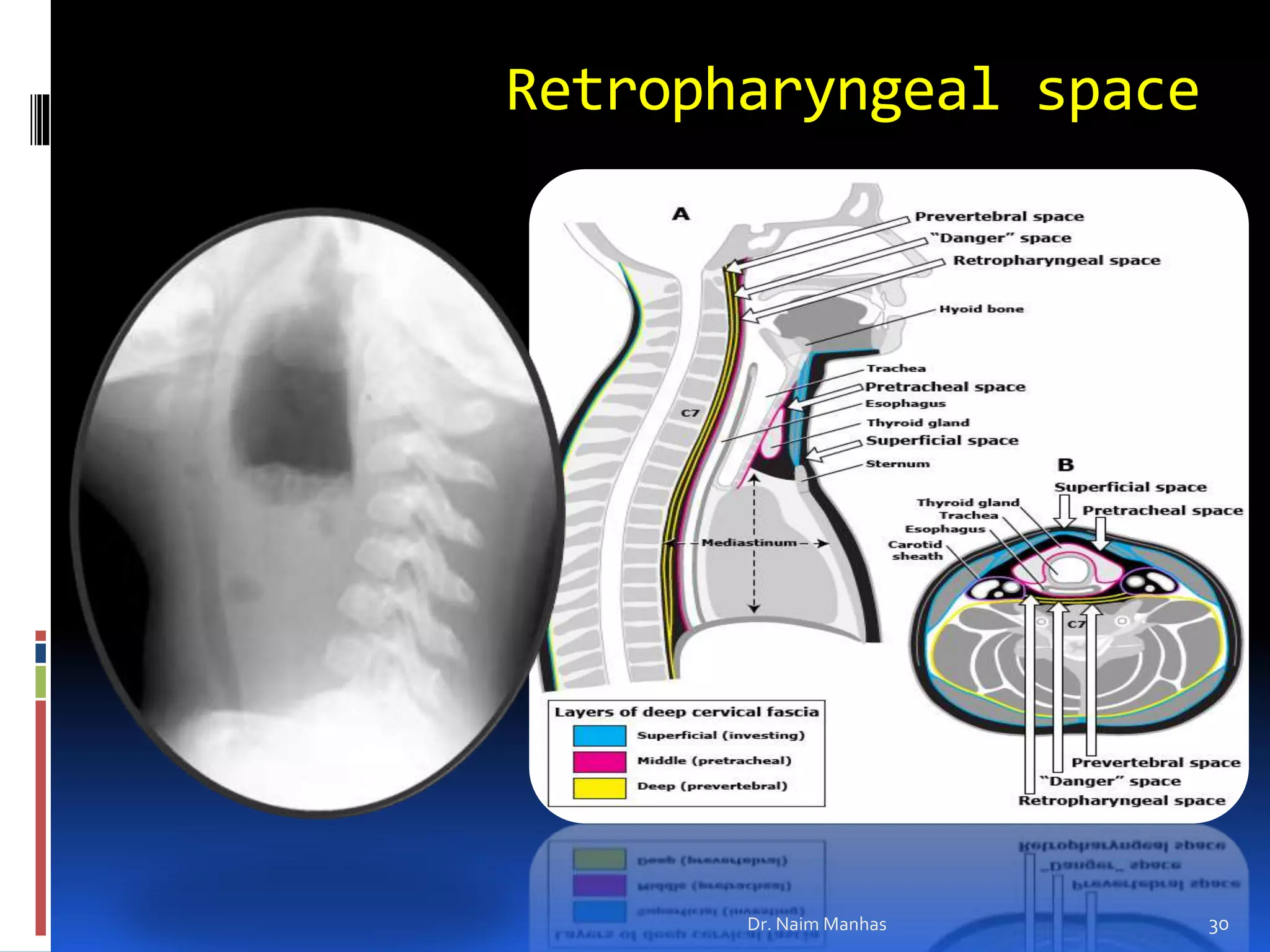 deep neck space infections | PPTX