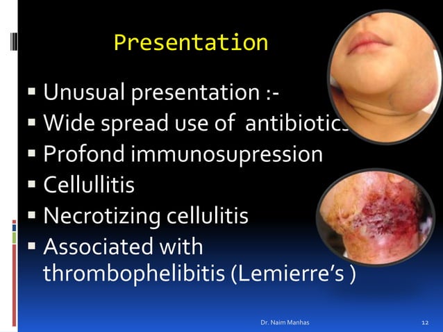 deep neck space infections | PPTX | Ear, Nose and Throat Conditions ...