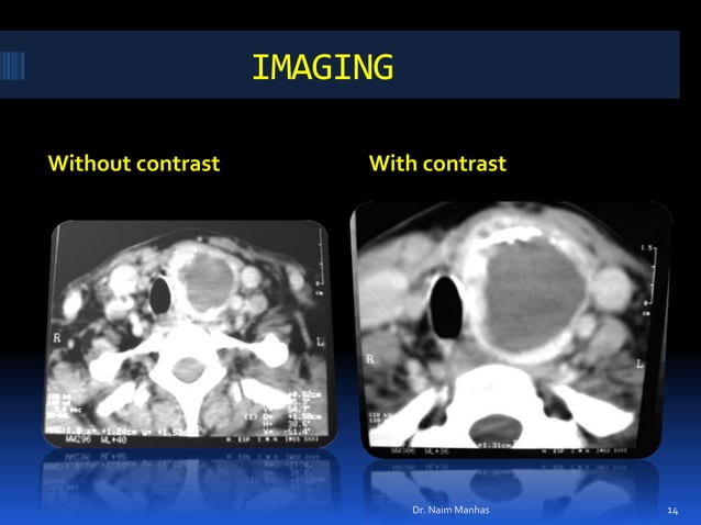 deep neck space infections | PPTX | Ear, Nose and Throat Conditions ...