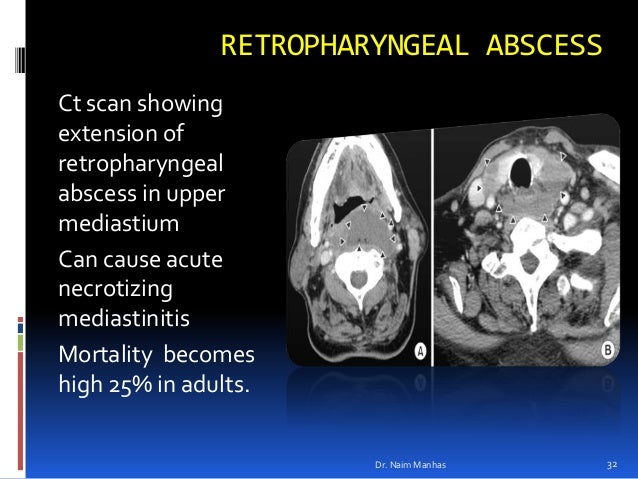 deep neck space infections