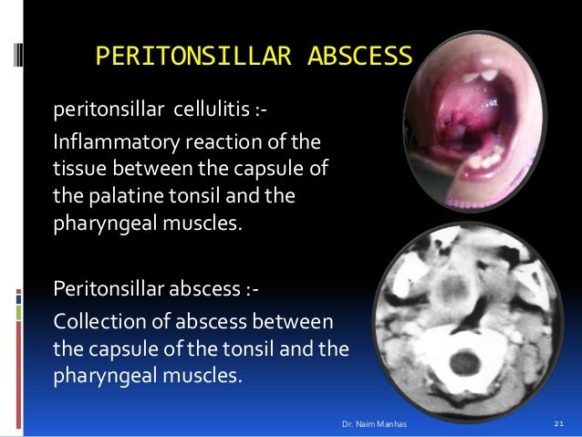 Tonsillar Cellulitis