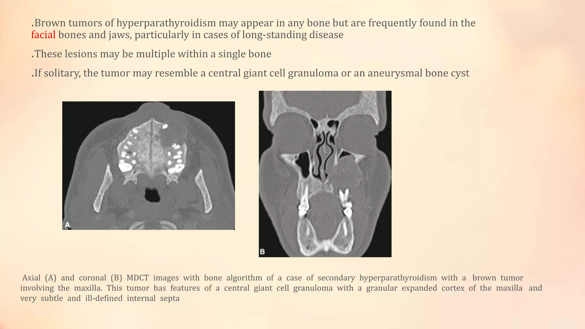 hyperparathyroidism in oral radiology | PPTX