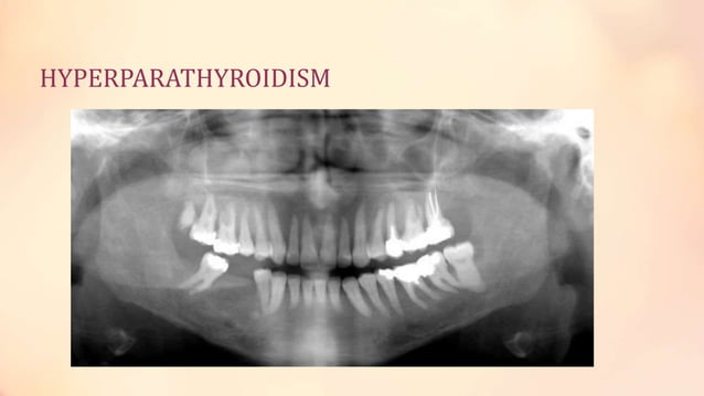 hyperparathyroidism in oral radiology | PPTX | Endocrine and Metabolic ...