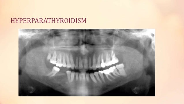 hyperparathyroidism in oral radiology