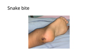 MANAGEMENT OF SNAKE BITE IN ACCIDENT AND EMERGENCY DEPT | PPTX