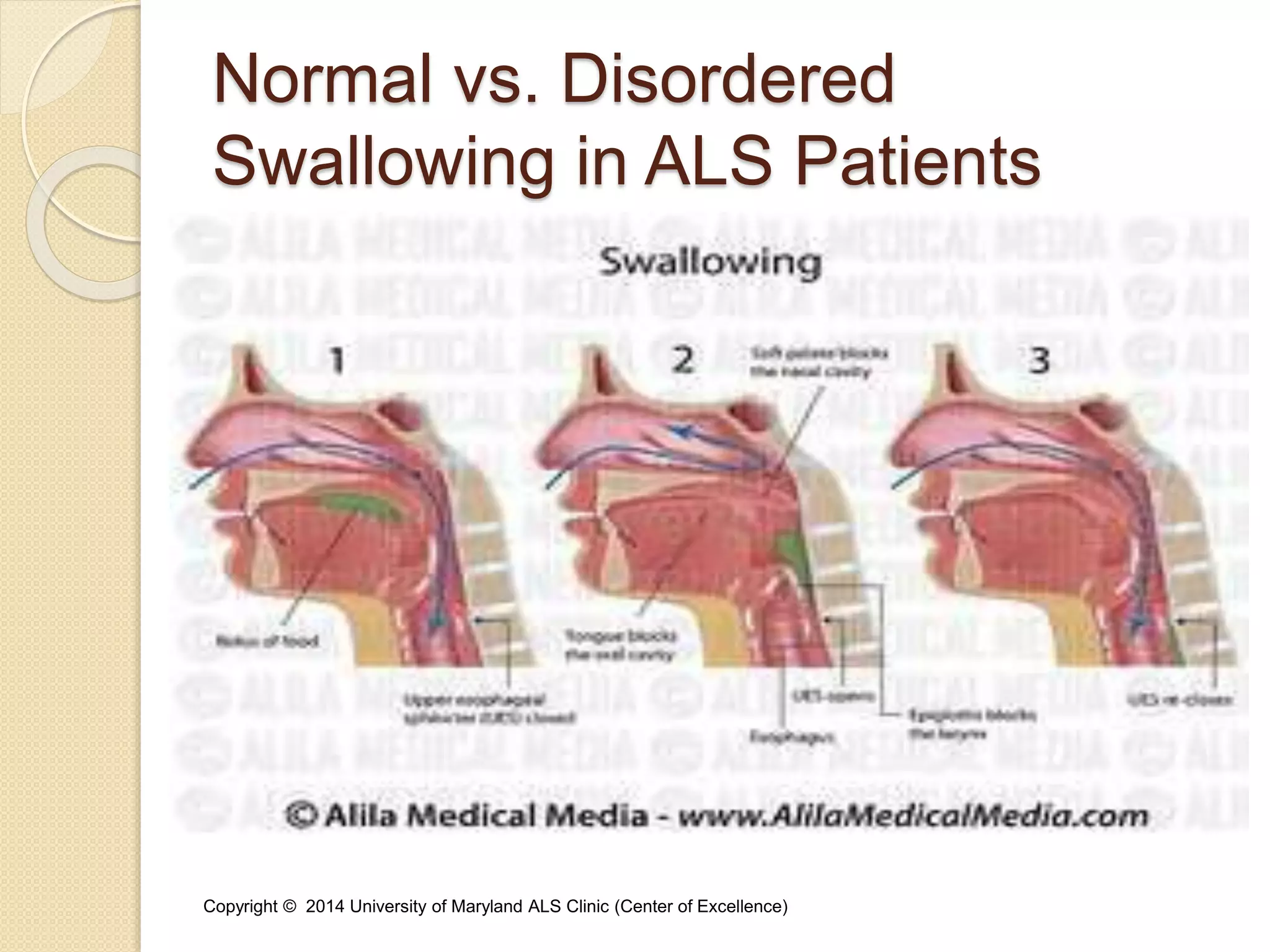 Presentation 228 denise epps neurogenic dysphagia- role of slp in dysphagia management of als ...