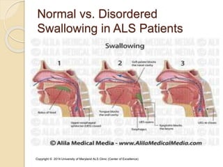 Presentation 228 denise epps neurogenic dysphagia- role of slp in ...