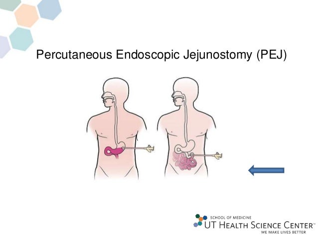 Presentation 229 b pamela kittrell safety of peg tube insertion in pa…