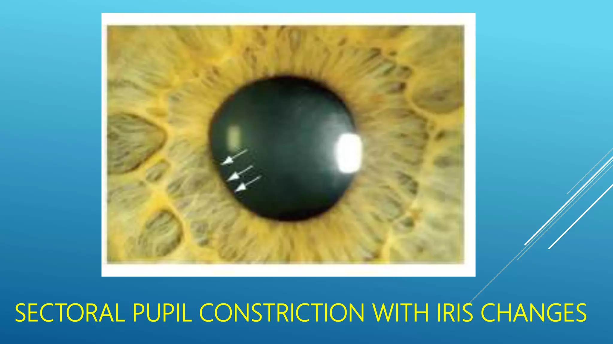 Ciliary ganglion | PPTX