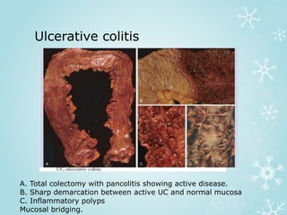 benign and malignant lesions of the intestines | PPTX
