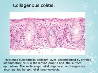 benign and malignant lesions of the intestines | PPTX