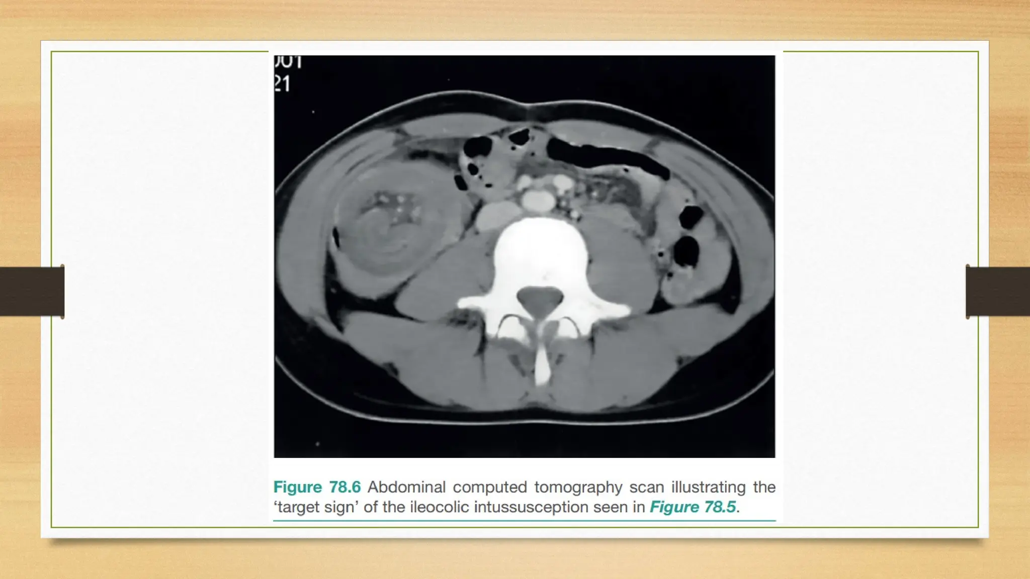 Intussusception in children and adults.pptx