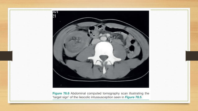 Intussusception in children and adults.pptx
