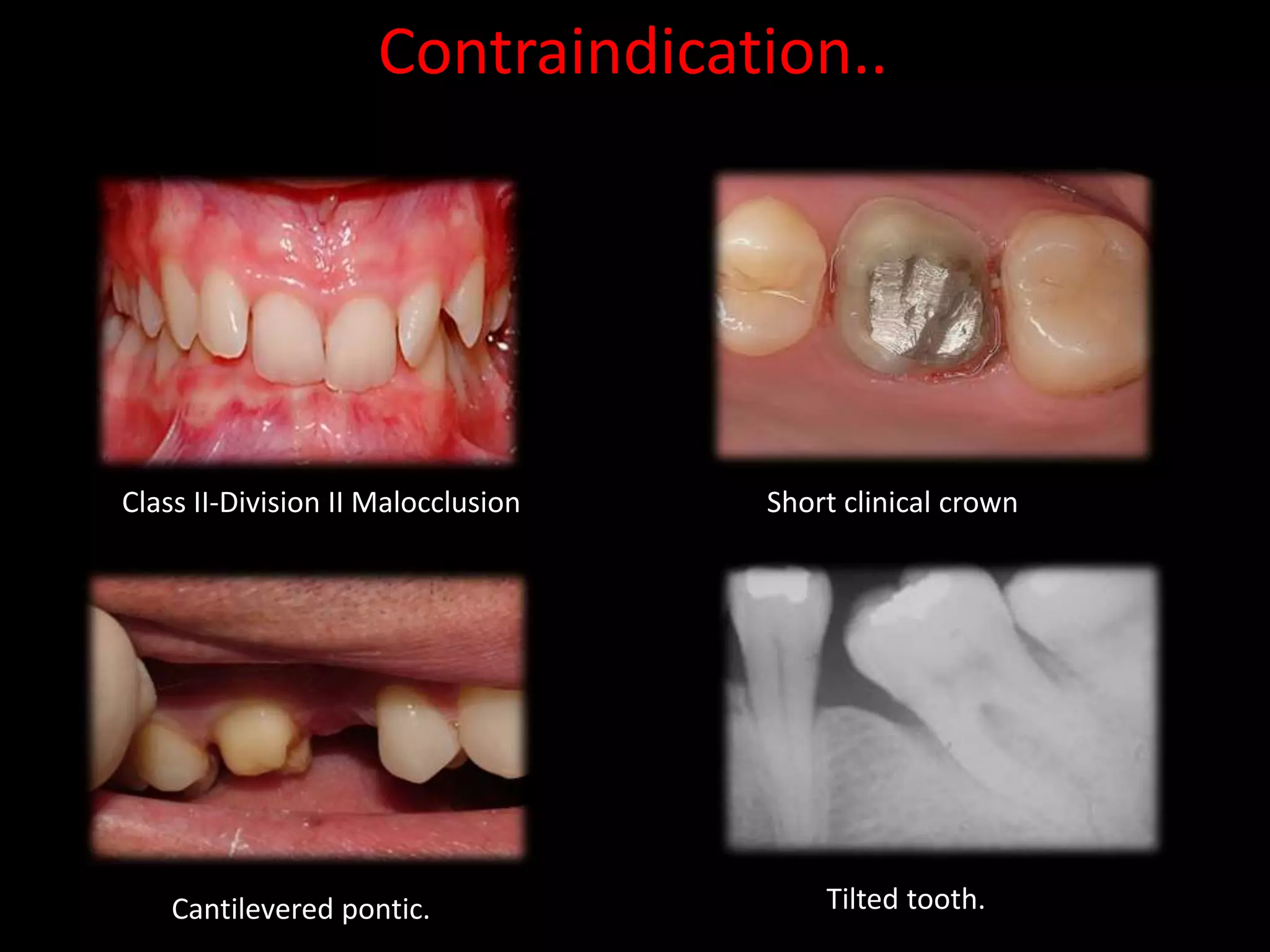 zirconia in prosthodontics. | PPTX