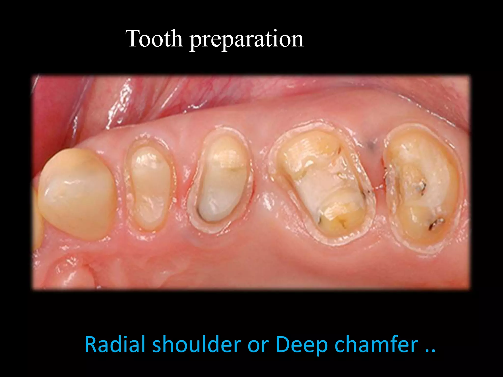 zirconia in prosthodontics. | PPTX
