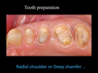 zirconia in prosthodontics. | PPTX