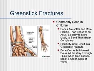 Presentation2 Fractures | PPT