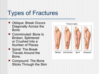 Presentation2 Fractures | PPT
